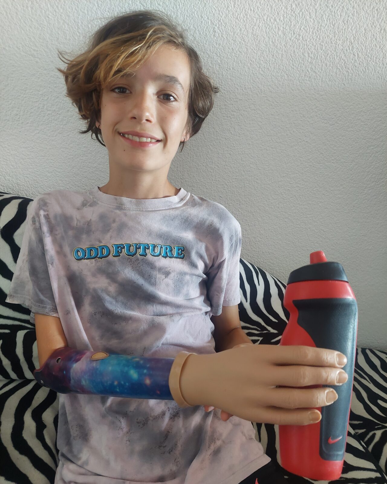 Felix finally approved for a myoelectric arm - talking to Dario who ...